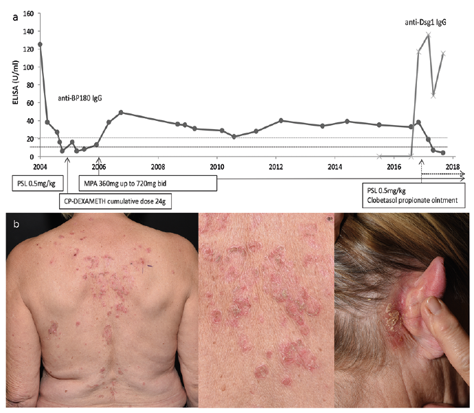 Pemphigoid Vs Pemphigus